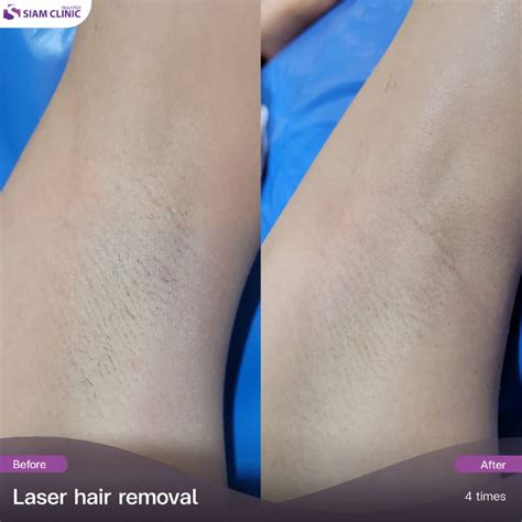 Armpit Laser Hair Removal Siam Clinic Aesthetic And Wellness Clinic