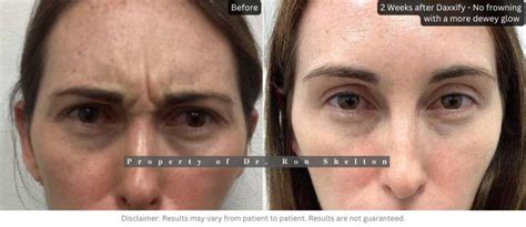 NYC Daxxify Before And After Ron Shelton M D Patient Photos