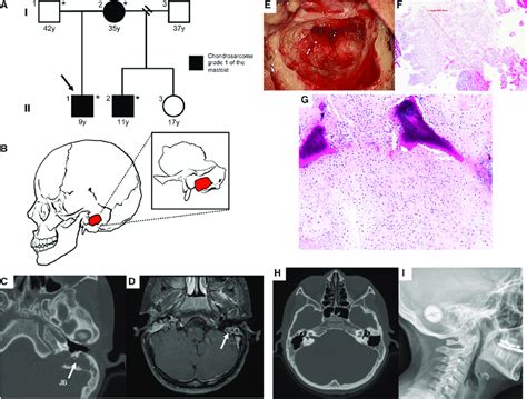 Overview Of The Clinical And Pathological Presentation Of Mastoid
