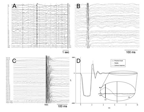 Illustrations Of Immediate Artifact Recorded After Tms Pulse A And B Download Scientific