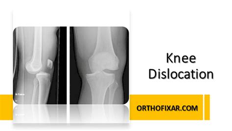 Knee Dislocation Diagnosis And Treatment Orthofixar
