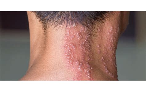 Sussex Health Treating Shingles Sussex Exclusive