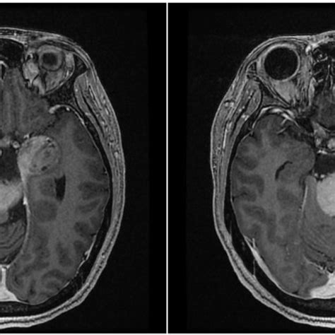Dural Tail Observed On Gadolinium Enhanced T1 Weighted Magnetic