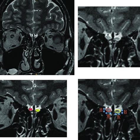 A Whole Brain Mr Scan From A Single Subject B Right And Left Ob Of Download Scientific