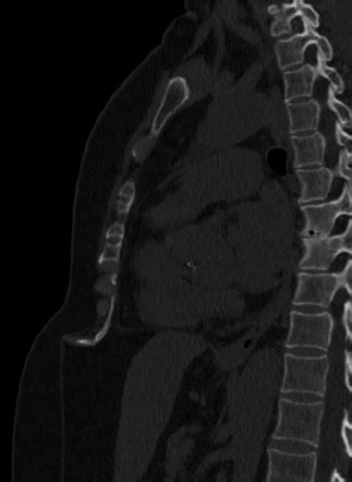 Bifid Xiphoid Process