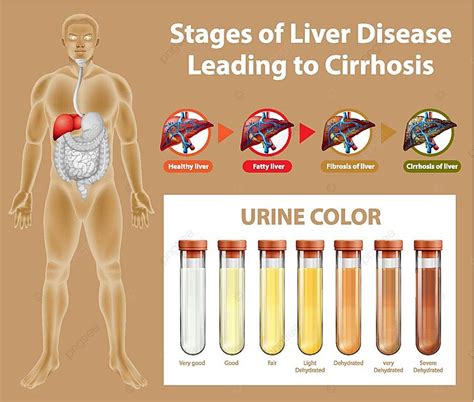 Liver Failure Urinary Incontinence At Concepcion Kearns Blog