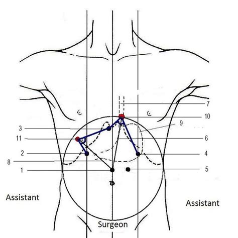 Port Arrangement Video Port Retractor Functional Surgeon Download Scientific Diagram