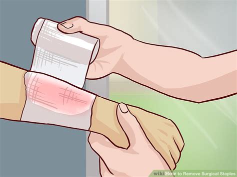 How To Remove Surgical Staples 8 Steps With Pictures WikiHow