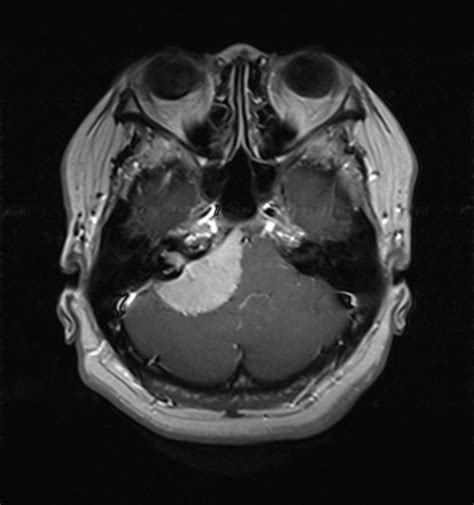 Dural Tail Sign Pacs