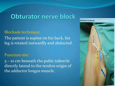 Ppt Peripheral Nerve Blocks Using Nerve Stimulator Powerpoint