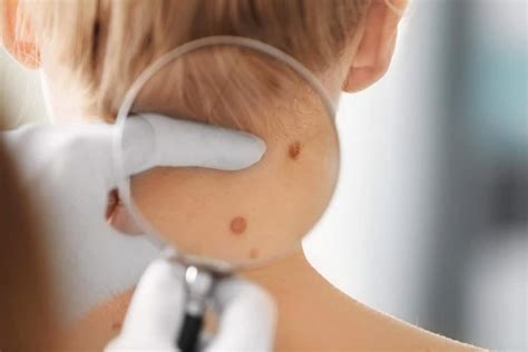 Cyst Removal Aftercare How To Heal Quickly And Avoid Infection Aventus