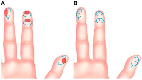 The Two Point Discrimination Test 2 Pdt To Perform The 2 Pdt The