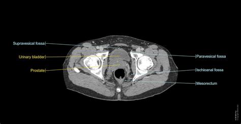 Ischiorectal Fossa Cadaver