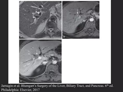 Hilar Cholangiocarcinoma In My Point Of View Pptx