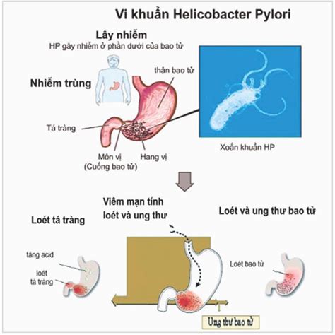 Sự Thật ít Biết Về Loại Vi Khuẩn Hp Gây Ung Thư Dạ Dày Vi Khuẩn Hp Là