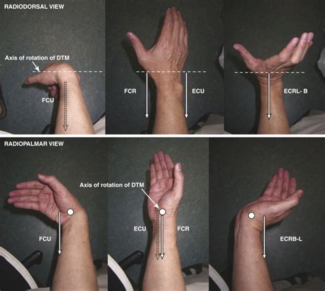 The Kinematics And Clinical Implications Of The Dart Throwing Motion