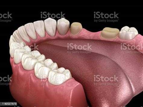 치과 다리 배치를 위한 준비된 어금니 및 소구치 치아 의학적으로 정확한 3d 일러스트레이션 건강관리와 의술에 대한 스톡 사진 및 기타 이미지 Istock