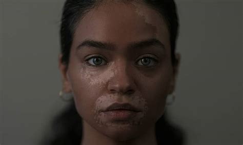 Vitiligo Causes Treatment And New Perspectives News Directory 3