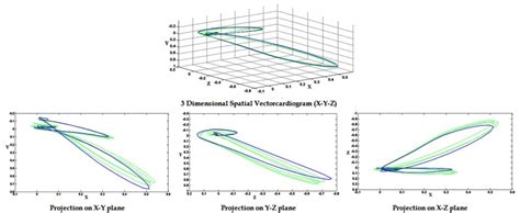 Vectorcardiogram At Collection Of Vectorcardiogram