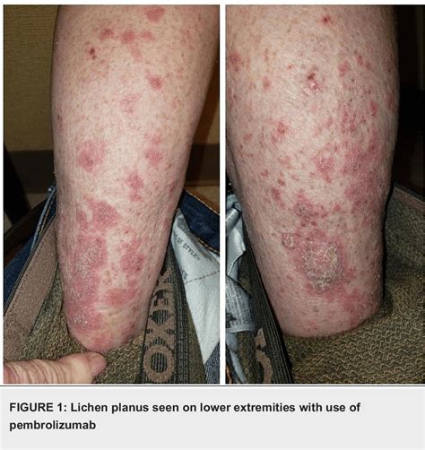 Figure 1 From Pembrolizumab Induced Lichen Planus In A Patient With Non Small Cell Lung