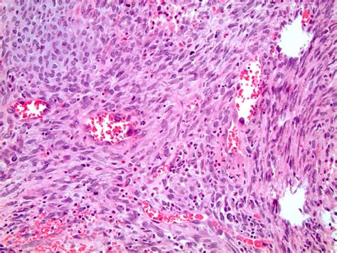 Testicular Teratoma Ultrasound