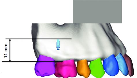 Infrazygomatic Crest Screw Placed Between Maxillary First And Second Download Scientific