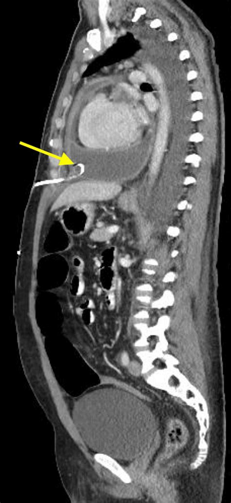 Ct Scan With Contrast Showing Pericardial Drainage Catheter In Situ In