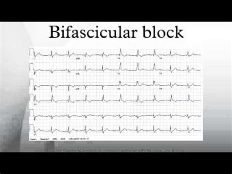 Bifascicular Block YouTube
