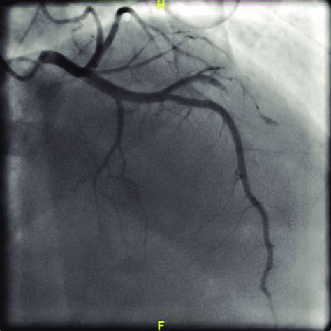 Second Diagonal Branch Of Left Anterior Descending Artery After Download Scientific Diagram