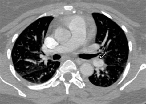 Frequency Of Pulmonary Embolism Amongst Patients Admitted For First