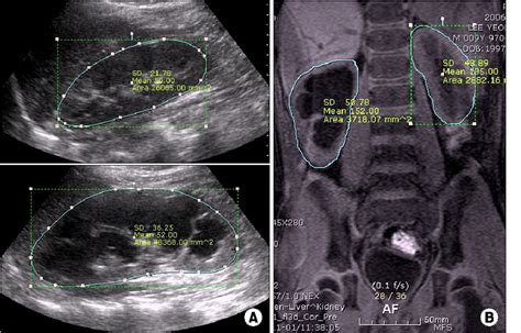 Figure 1 From Modified Differential Renal Function Measurement Revised By Renal Cross Sectional