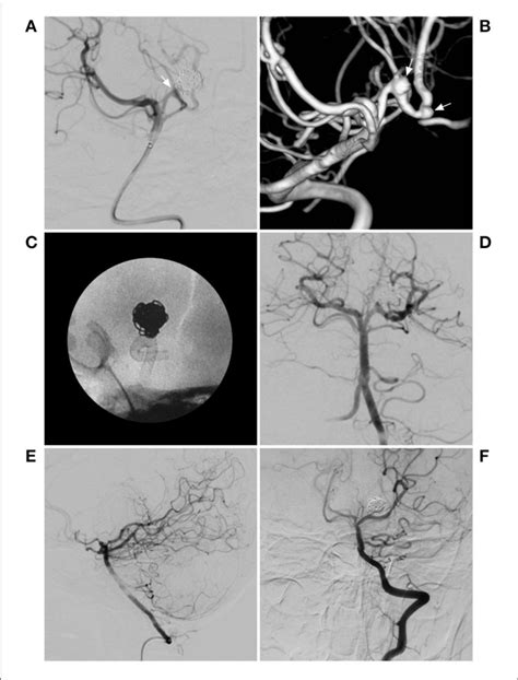 Ped For A Previously Coiled Recurrent Aneurysm A Dsa Of The Ba Download Scientific Diagram