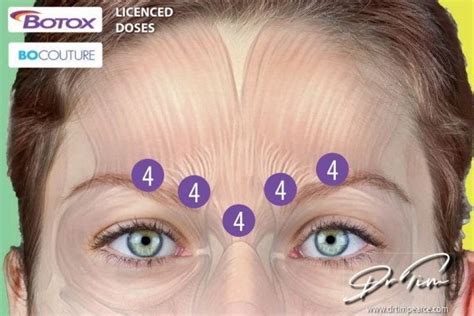 New BOTOX Pattern Should You Switch Dr Tim Pearce