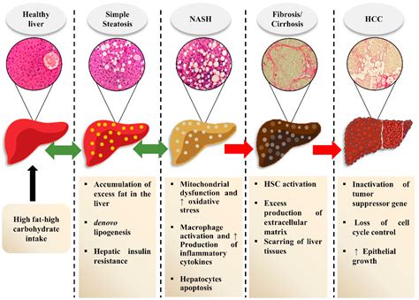 Non Alcoholic Liver Cirrhosis Diet Best Culinary And Food