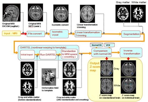 Table 1 From Voxel Based Morphometry Of Brain Mri In Normal Aging And Alzheimers Disease