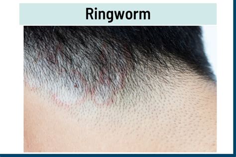 What Rash Looks Like Ringworm At Noah Hargrave Blog