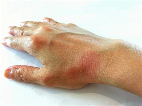 Could Novel Sex Linked Targets Provide Autoimmune Disease Therapies