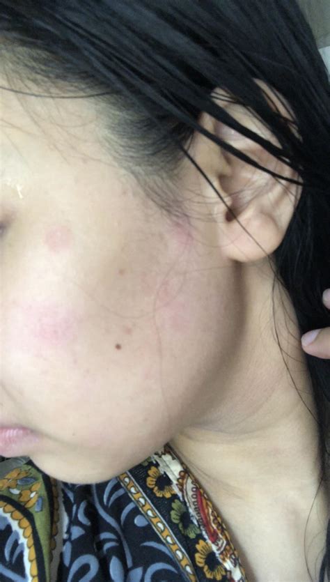 Please Help Is This Ringworm On My Cheek I Do Have History Of Eczema