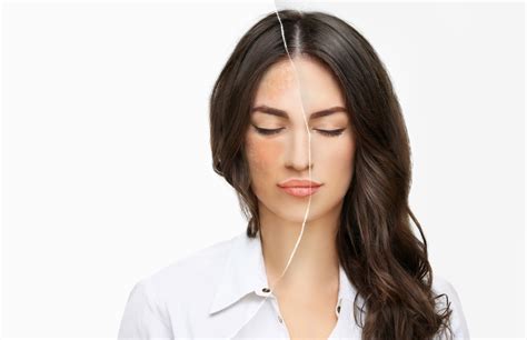 Understanding Melasma Causes Symptoms And Treatments