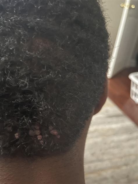 How To Get Rid Of It R Folliculitis