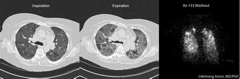 Roentgen Ray Reader Mosaic Attenuation