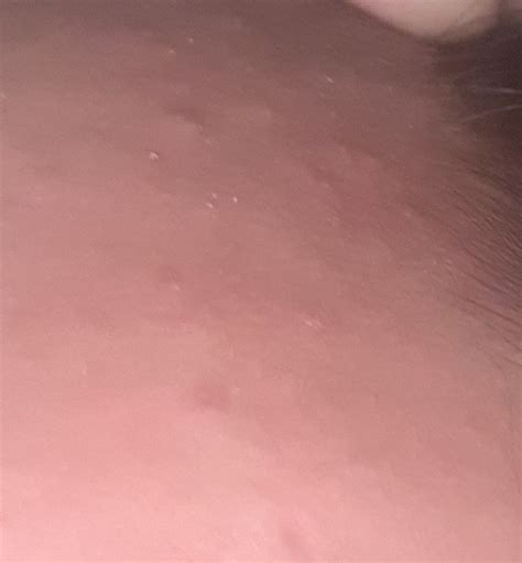 약혐 이마에 뭐가 났는데 뭔지 모르겠어요 지식in