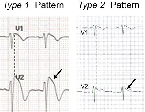 Brugada Syndrome Diagnostic Pitfalls Journal Of Emergency Medicine