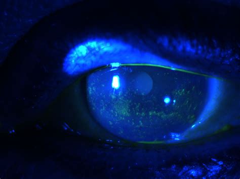 Dry Eyes In Ectodermal Dysplasias Nfed