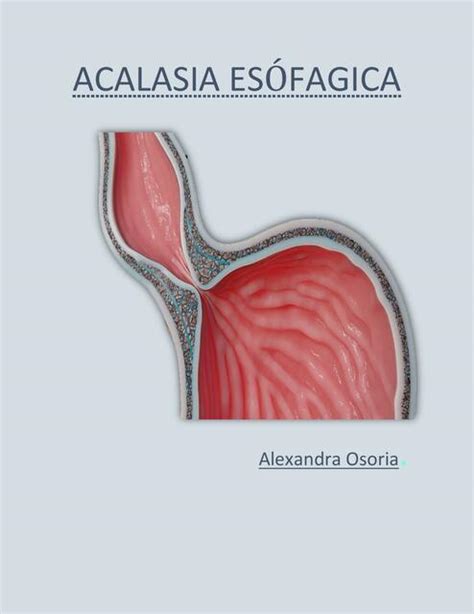 Acalasia Esófagica Osoria0599 Udocz