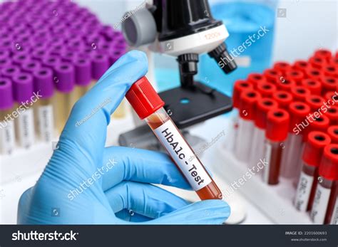 Hba C Test Blood Blood Samples Be Stock Photo Shutterstock