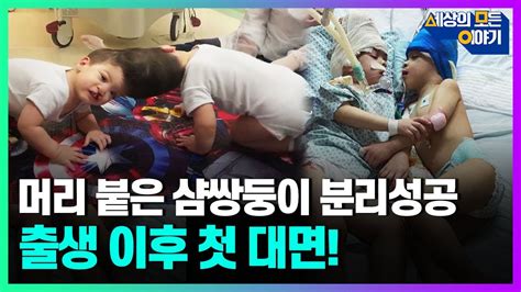 의료진들의 집념으로 머리 붙은 샴쌍둥이 3년 만에 서로 얼굴 봐ㅣ세모이 [27회] Ytn2 Youtube