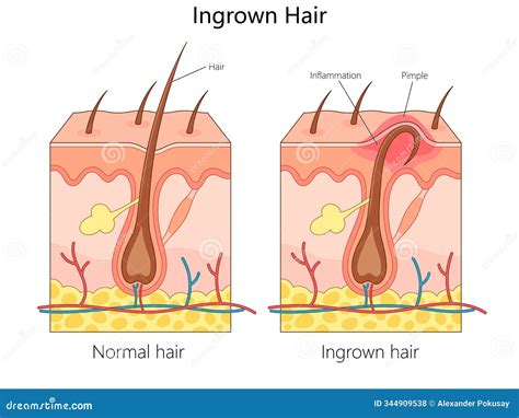 Normal And Ingrown Hair Structure Diagram Medical Stock Vector