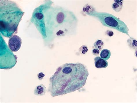 Hsil Is Shown Liquid Based Preparation Thinprep In This Specimen