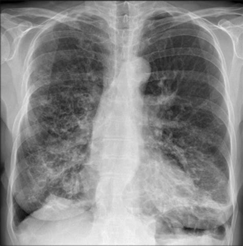 Bronchiectasis Flashcards Quizlet